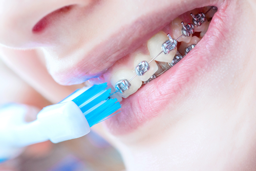What to Expect with Braces: Complete Guide for Teens & Parents